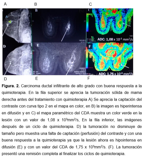 Resonancia magnética funcional por difusión en el diagnóstico del ...
