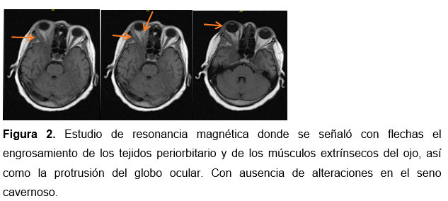 Pseudotumor inflamatorio de la órbita. Presentación de un caso ...