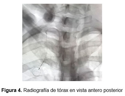 Colocación de reservorio subcutáneo venoso central permanente | Vázquez ...